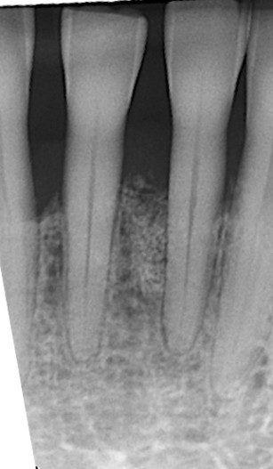 Langzeitstabilität bei vertikalen Knochendefekten – ZWP online – das ...