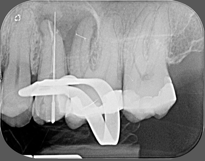 Einzelzahnimplantat mit Weichgewebeaufbau – ZWP online – das ...