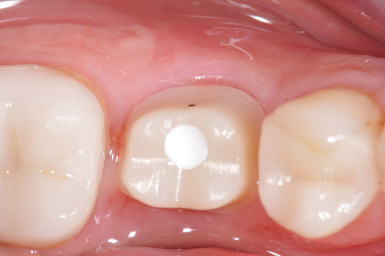 Individuelle PEEK-Gingivaformer und Abformpfosten – ZWP online – das Nachrichtenportal für die ...