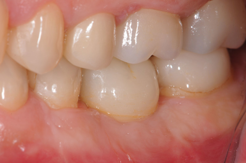 Individuelle PEEK-Gingivaformer und Abformpfosten – ZWP online – das Nachrichtenportal für die ...