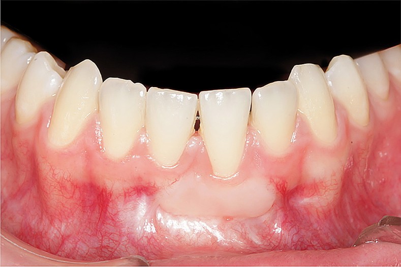 Minimalinvasive plastische Parodontalchirurgie – ZWP online – das ...