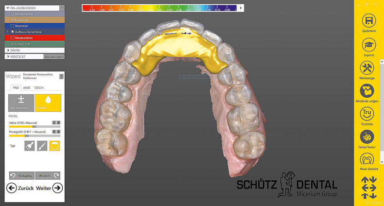 Digitales Praxiskonzept: Die modellfreie Schiene – ZWP online – das ...
