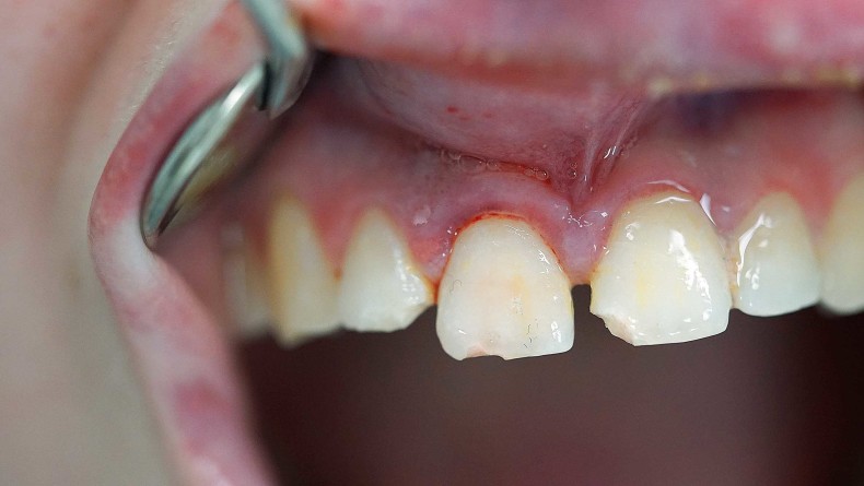 Versorgung eines Frontzahntraumas in Verbindung mit ...