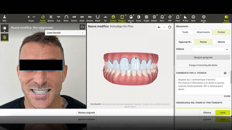 Invisalign Smile Architect™ revolutioniert die KFO und Prothetik – ZWP ...