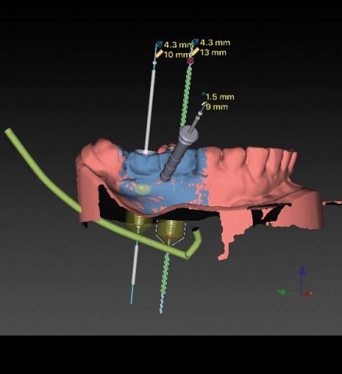 Der digitale Workflow in der Implantologie – ZWP online – das Nachrichtenportal für die ...