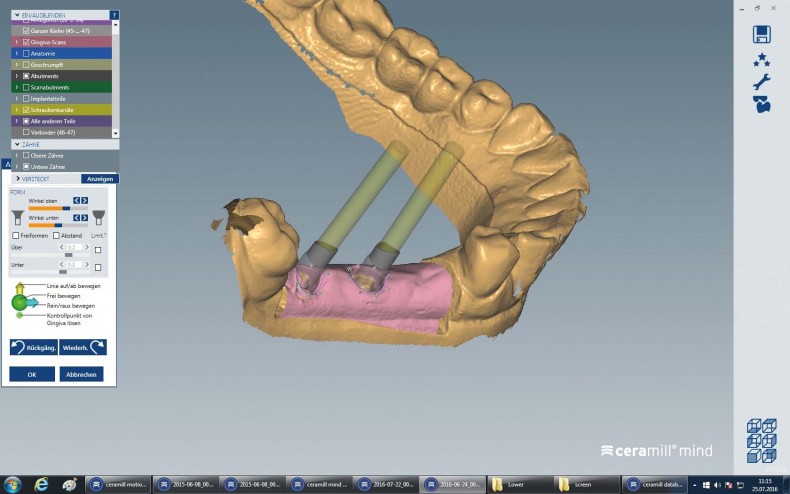 Der digitale Workflow in der Implantologie – ZWP online – das Nachrichtenportal für die ...