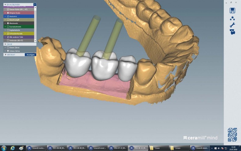 Der digitale Workflow in der Implantologie – ZWP online – das Nachrichtenportal für die ...