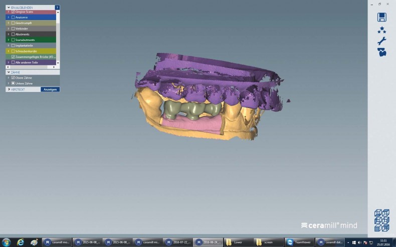 Der digitale Workflow in der Implantologie – ZWP online – das Nachrichtenportal für die ...