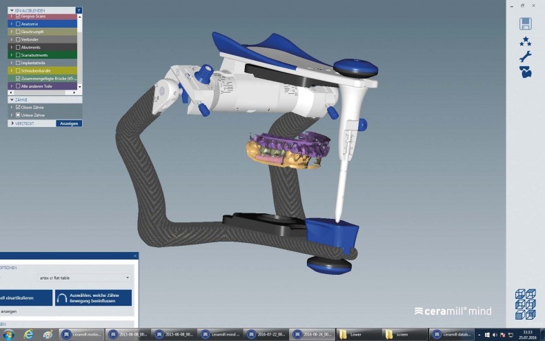 Der digitale Workflow in der Implantologie – ZWP online – das Nachrichtenportal für die ...