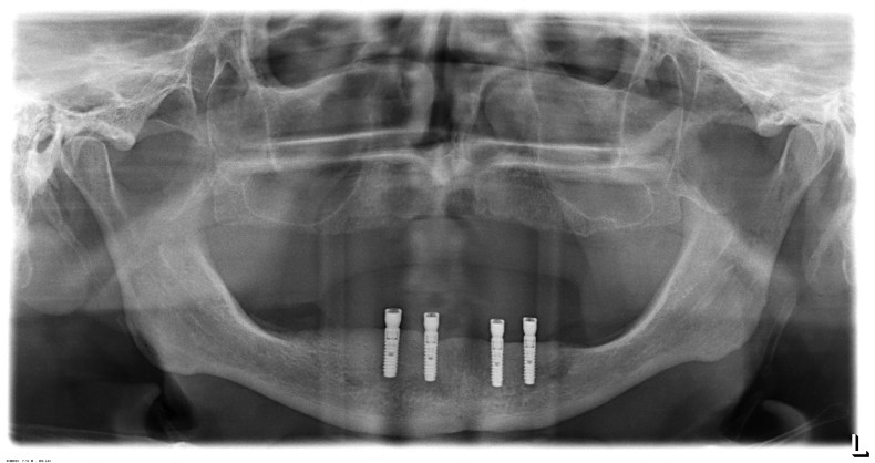 Präfabrizierte Attachments für Implantatversorgungen – ZWP online – das ...
