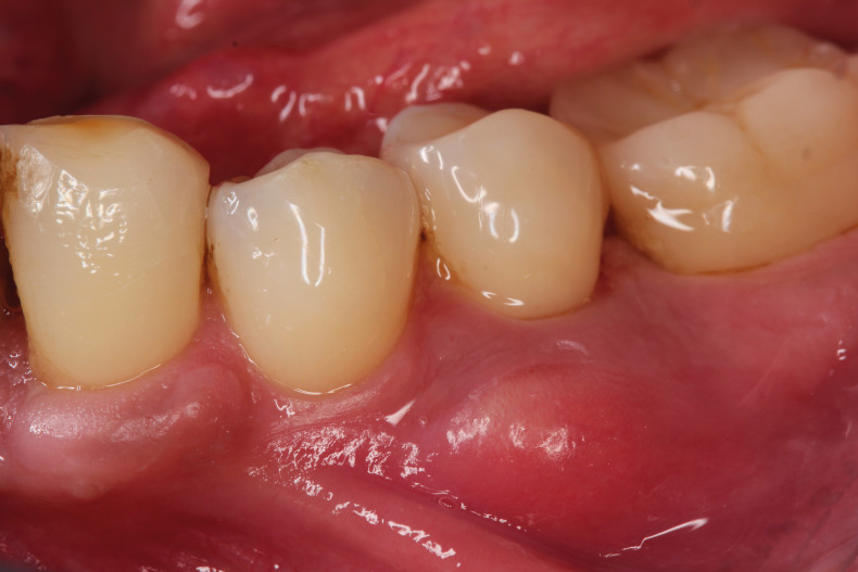 Komplikationen während und nach der zahnärztlichen Prophylaxe – ZWP ...