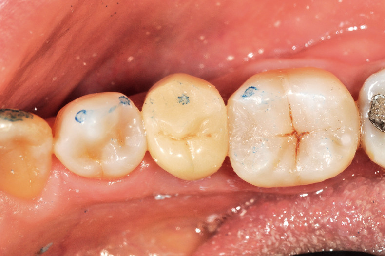 Die effiziente postendodontische Behandlung – ZWP online – das ...