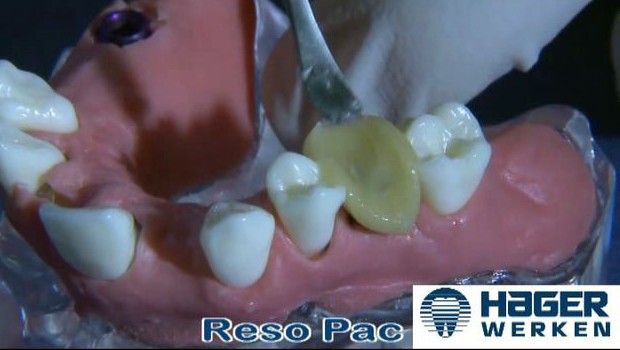 Reso-Pac - der besondere Zahnfleischverband – ZWP online – das ...