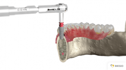 BEGO Implant Systems GmbH & Co. KG – ZWP online – das Nachrichtenportal ...