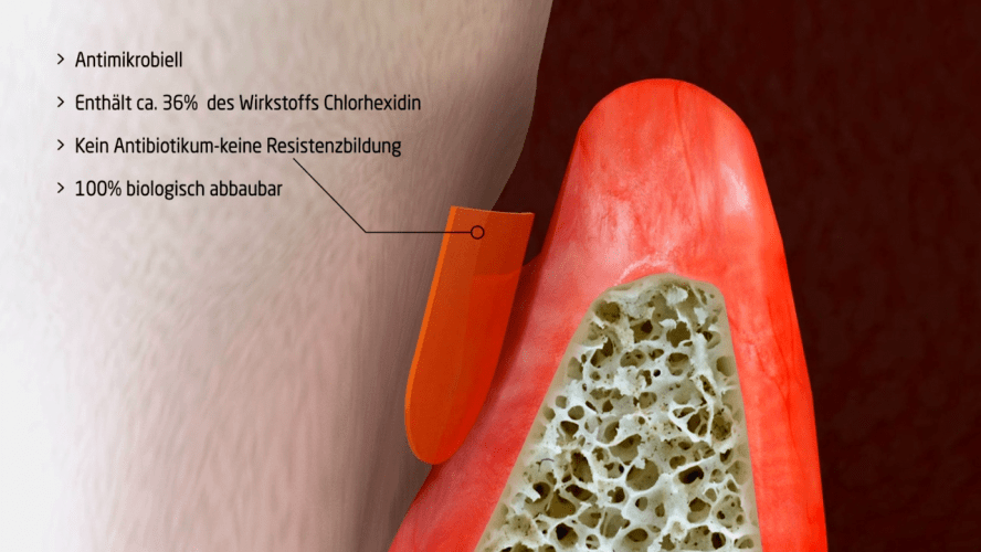 PerioChip® – Ohne Antibiotika gegen paropathogene Keime – ZWP online ...